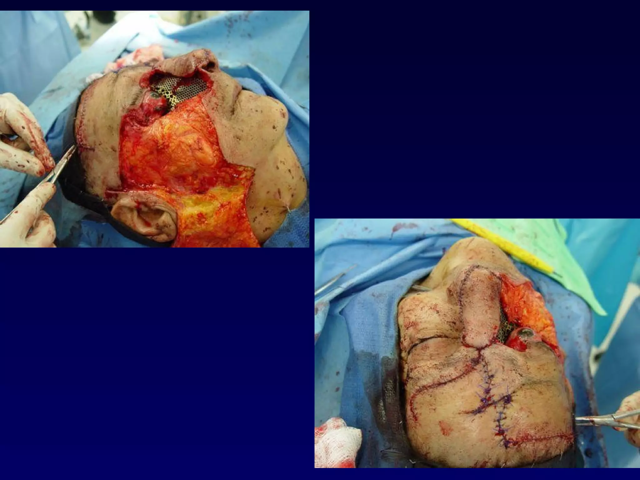 Infiltrating Basal cell carcinoma Infiltrating Basal cell carcinoma | PPT