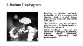 Gastro esophageal reflux disease (GERD).pptx