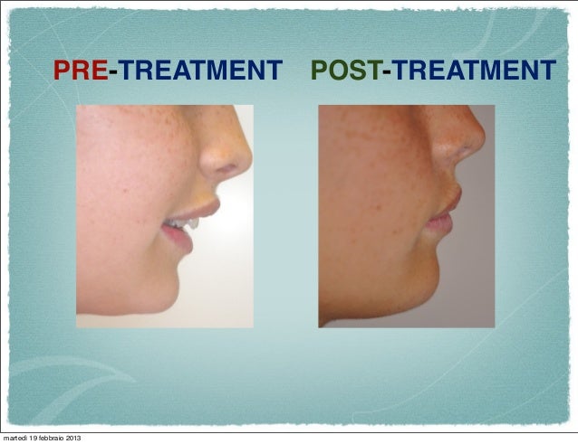 How change upper lip position with orthodontic terapy