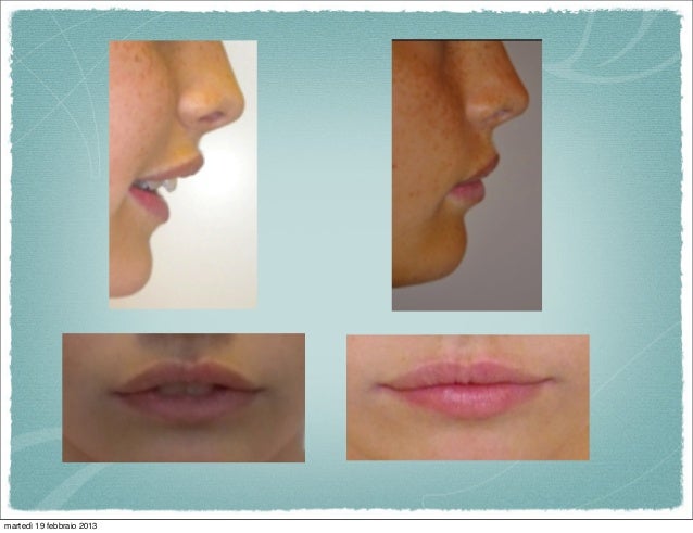 How change upper lip position with orthodontic terapy