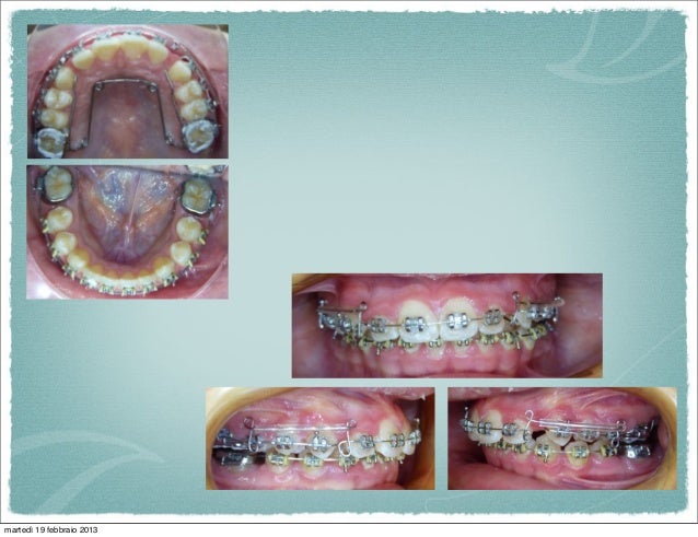 How change upper lip position with orthodontic terapy