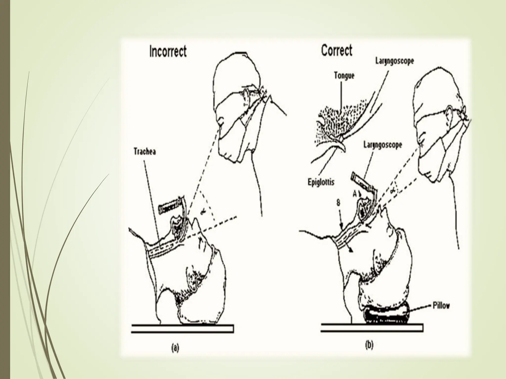 Endotracheal-Intubation is a procedure to save the human life from any ...