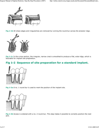 Surgical Manual Of Implant Dentistry Stepbystep Procedures Hardcover ...