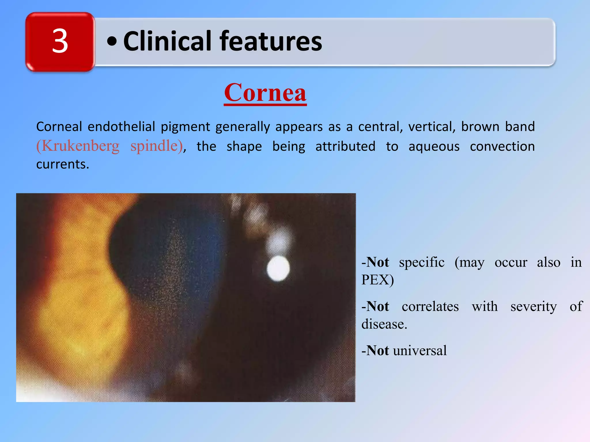 pigment dispersion syndrome by Hala Fathi Hannot | PPTX