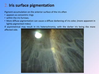 pigment dispersion syndrome by Hala Fathi Hannot | PPTX