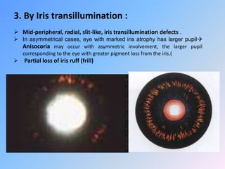pigment dispersion syndrome by Hala Fathi Hannot | PPTX