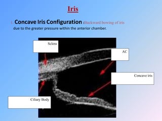 pigment dispersion syndrome by Hala Fathi Hannot | PPTX