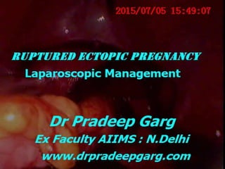 Ruptured Ectopic Pregnancy; Laparoscopic management: Dr Pradeep Garg | PPT
