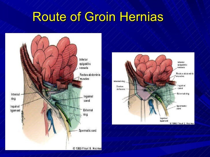 10 a.new groin hernias dr.fidel