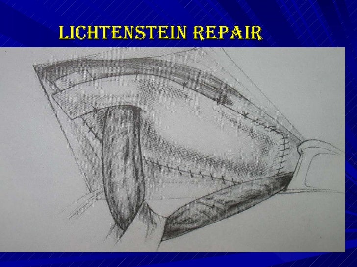 10 a.new groin hernias dr.fidel