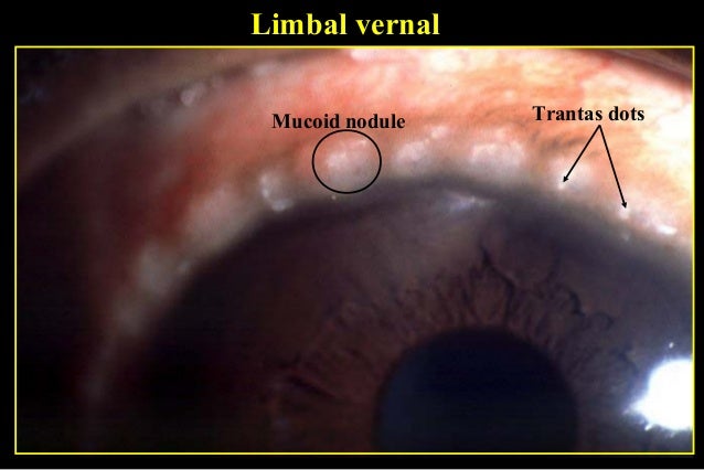 allergic conjunctivitis