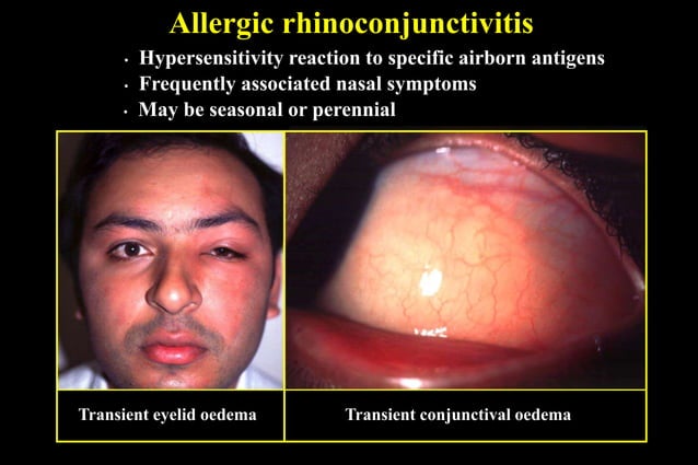 Allergic Conjunctivitis.ppt