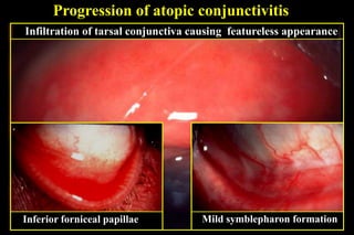 Allergic Conjunctivitis.ppt