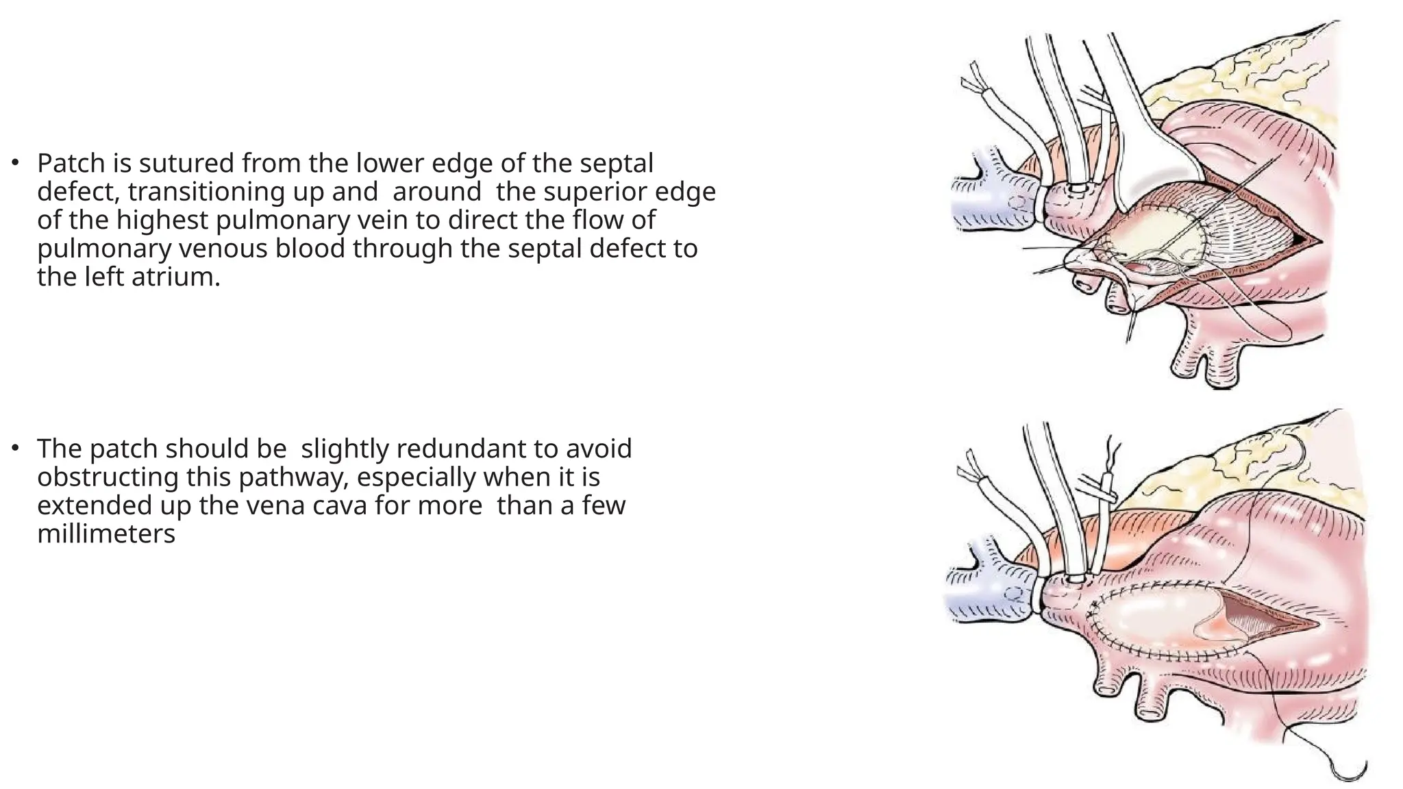 10 – Atrial septal defects Zeeshan.pptx