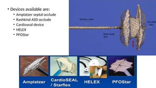 10 – Atrial septal defects Zeeshan.pptx