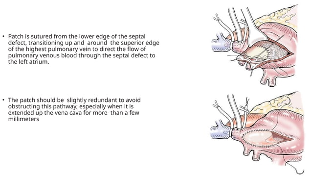 10 – Atrial septal defects Zeeshan.pptx