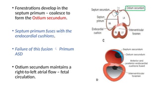 10 – Atrial septal defects Zeeshan.pptx