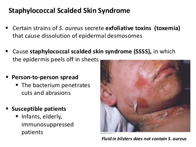 Staphylococcal Scalded Skin Syndrome Causes Symptoms