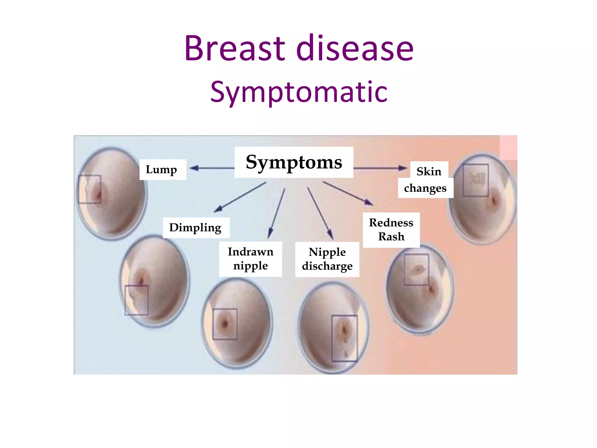 10 Breast Cancer Pdf