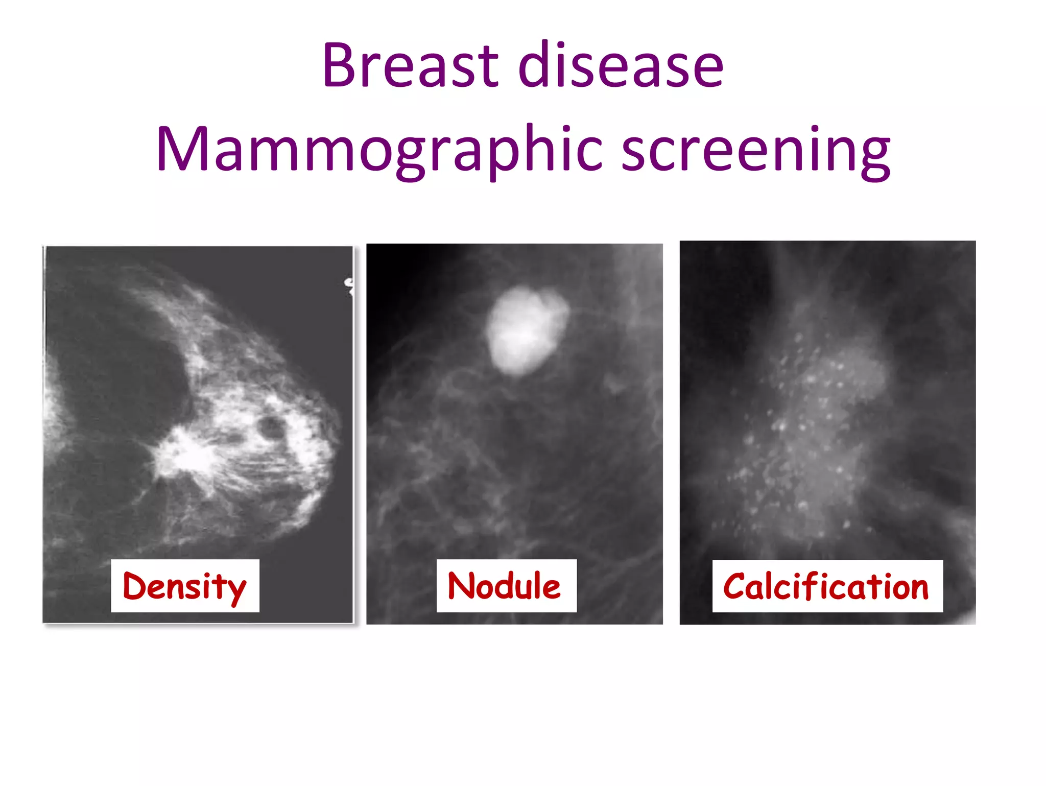 #10 Breast Cancer.pdf