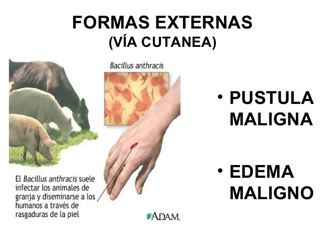 carbunco o antrax