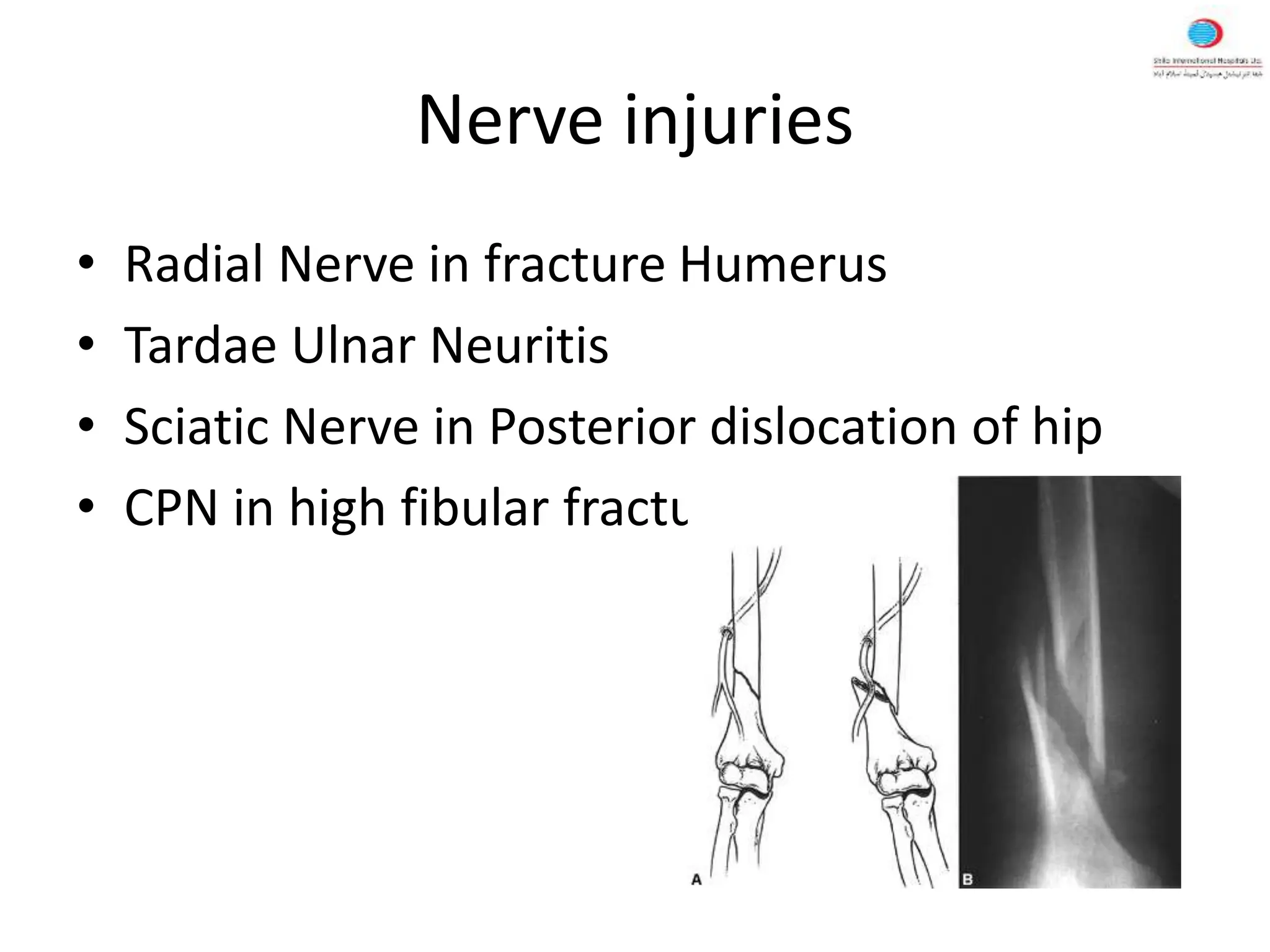 Complications of Fractures .pptx