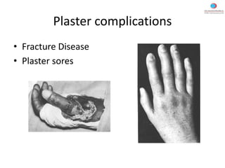 Complications of Fractures .pptx