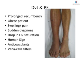 Complications of Fractures .pptx