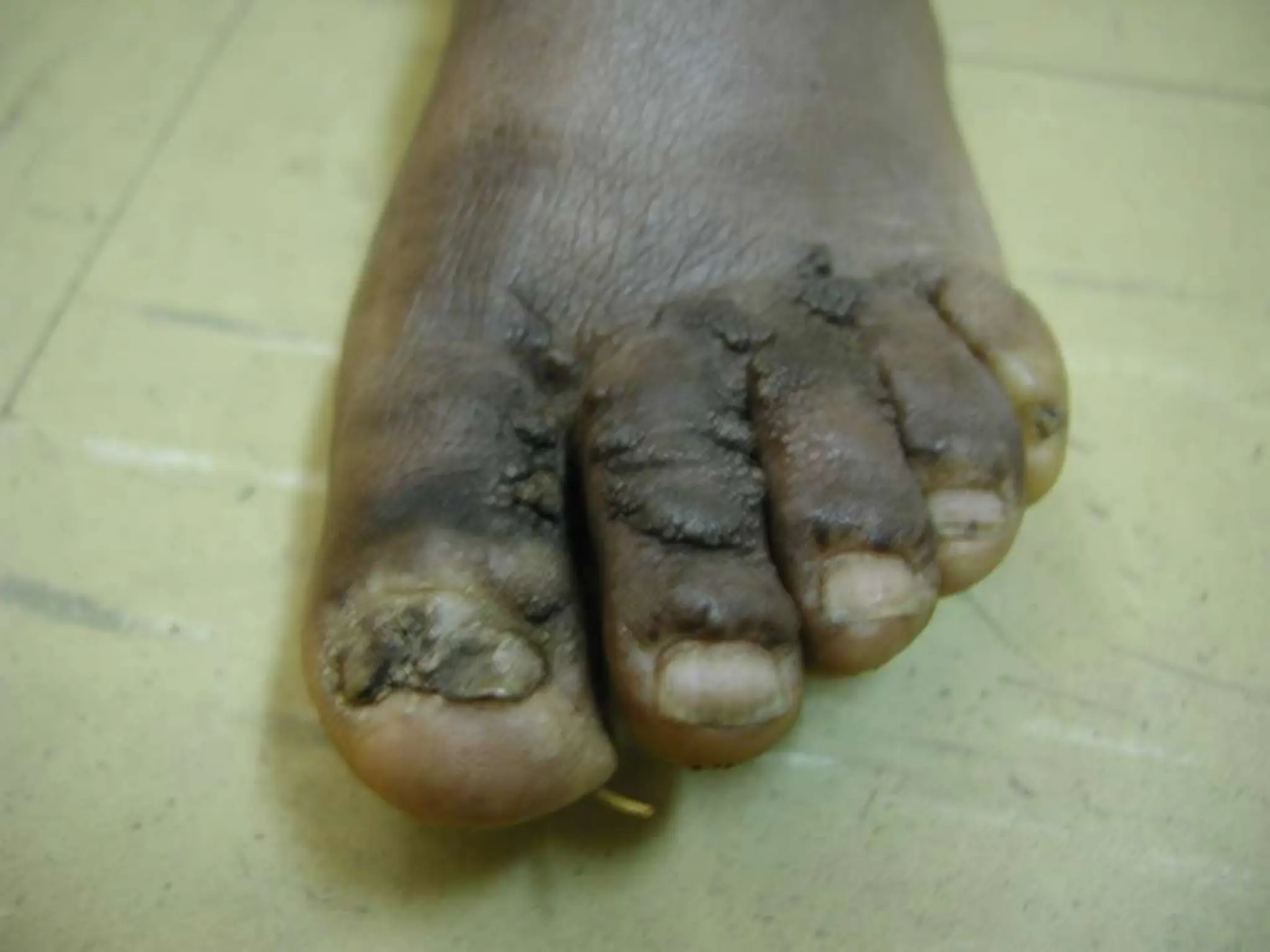 10Cutaneous Tuberculosis.ppt