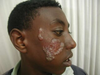 10Cutaneous Tuberculosis.ppt
