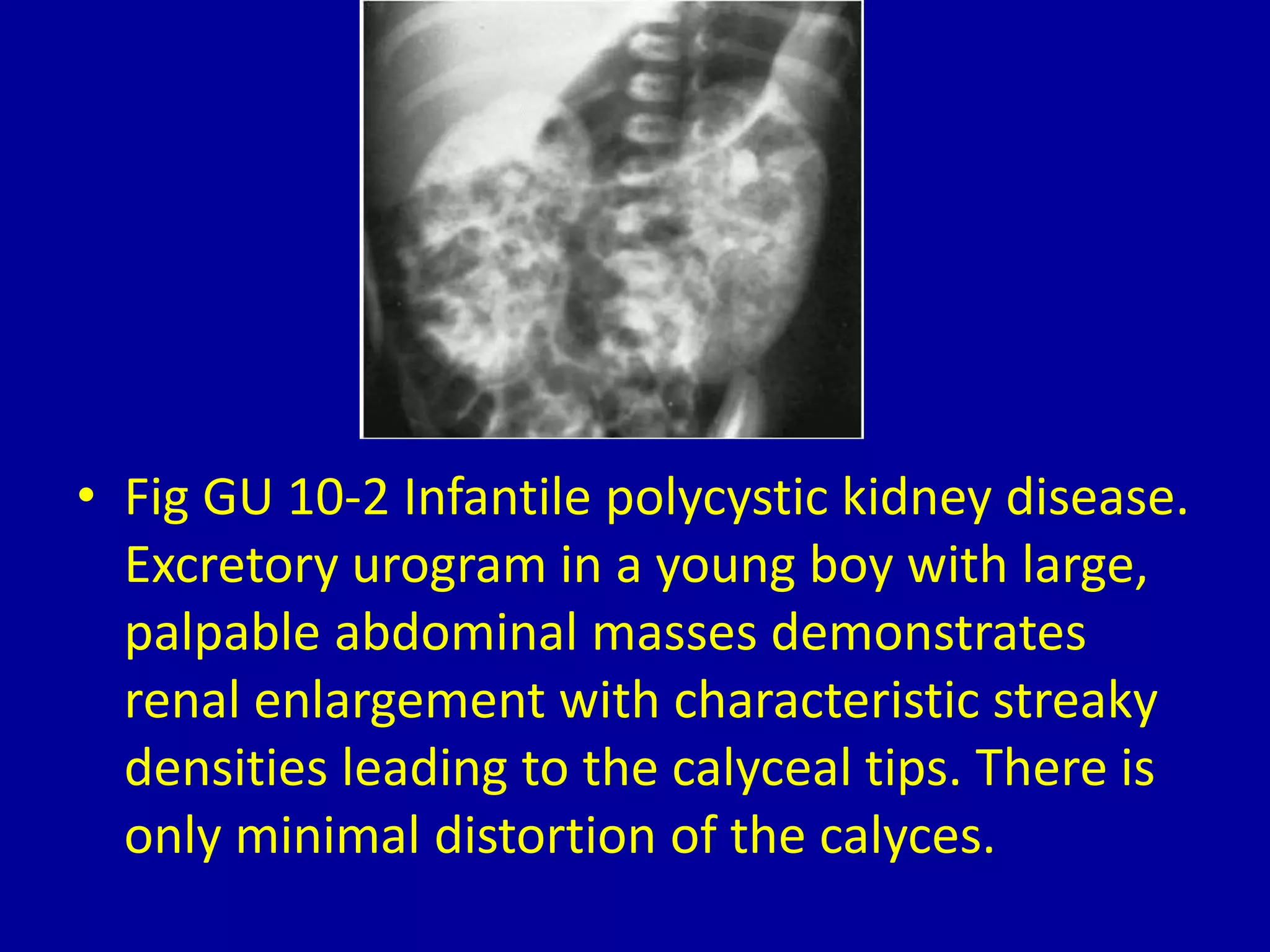 10 cystic diseases of the kidneys | PPTX