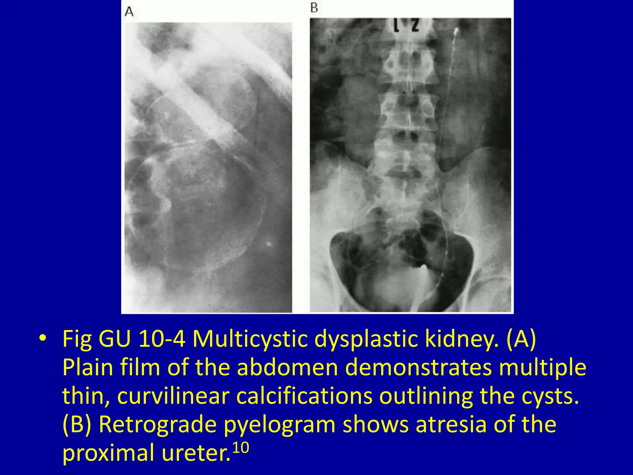 10 cystic diseases of the kidneys | PPTX