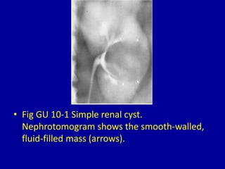 10 cystic diseases of the kidneys | PPTX | Science