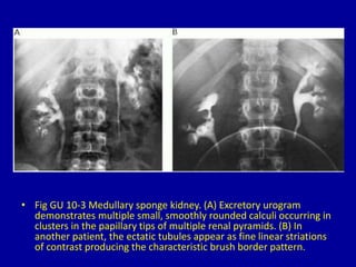 10 cystic diseases of the kidneys | PPTX | Science
