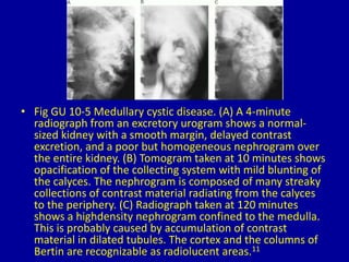 10 cystic diseases of the kidneys | PPTX | Science
