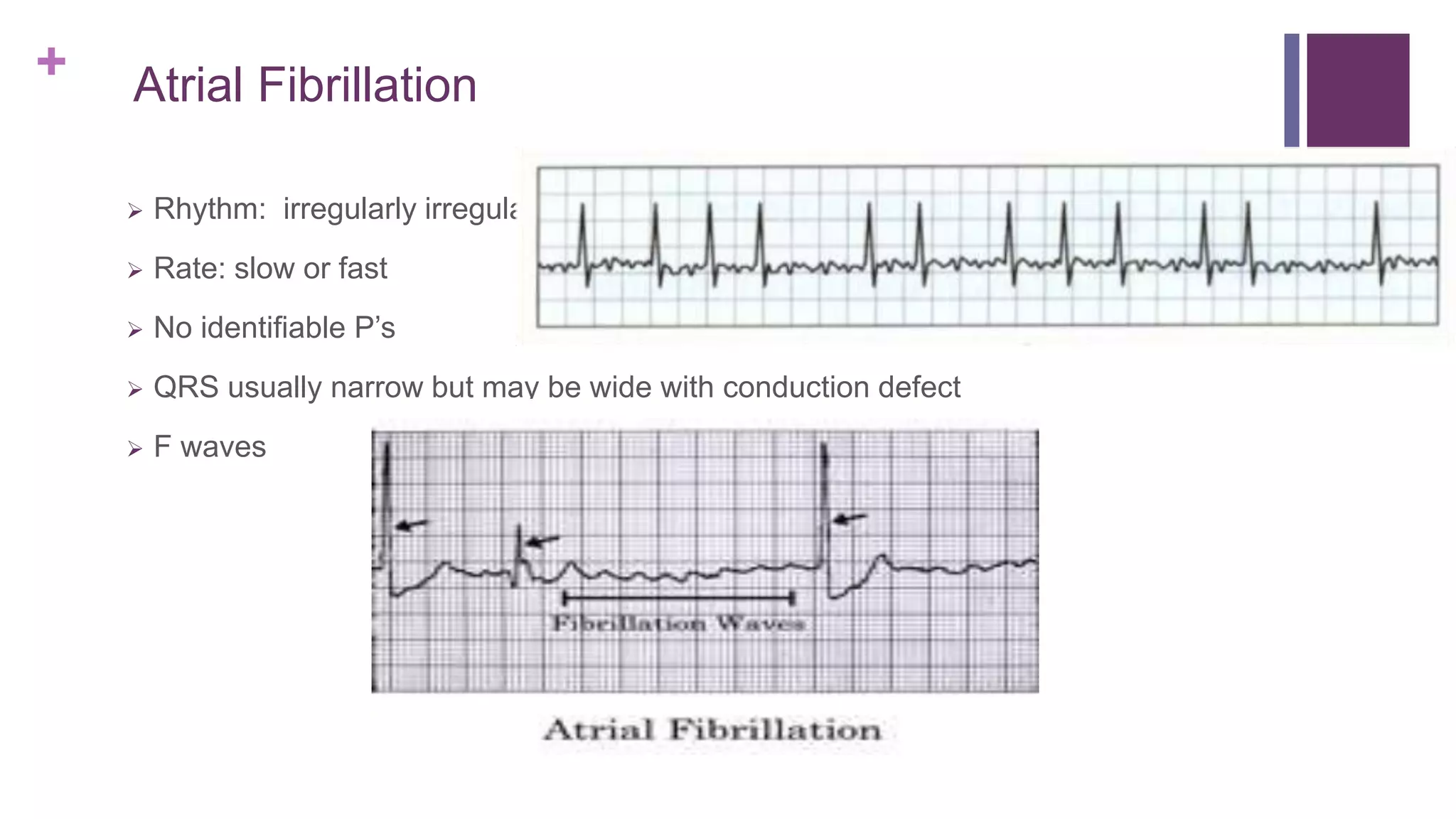 10 ECG interpret topic 10.pptx