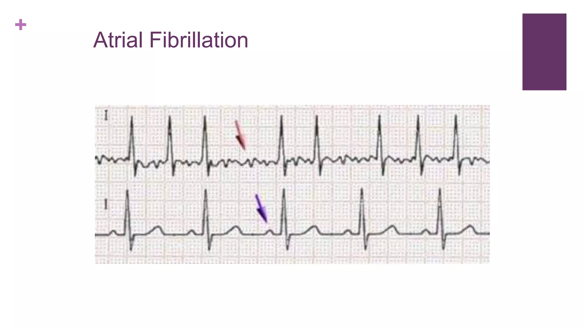 10 ECG interpret topic 10.pptx