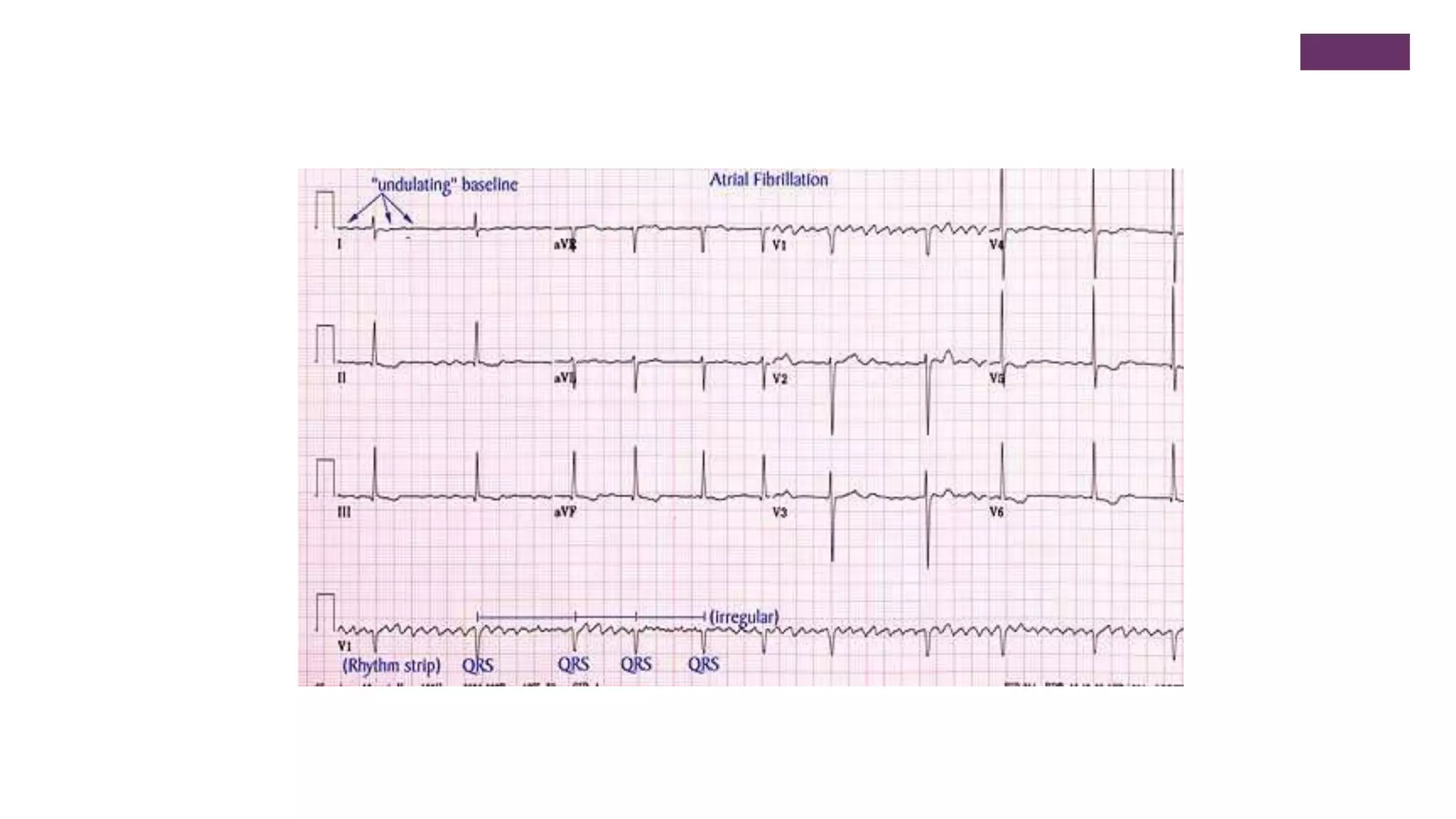 10 ECG interpret topic 10.pptx