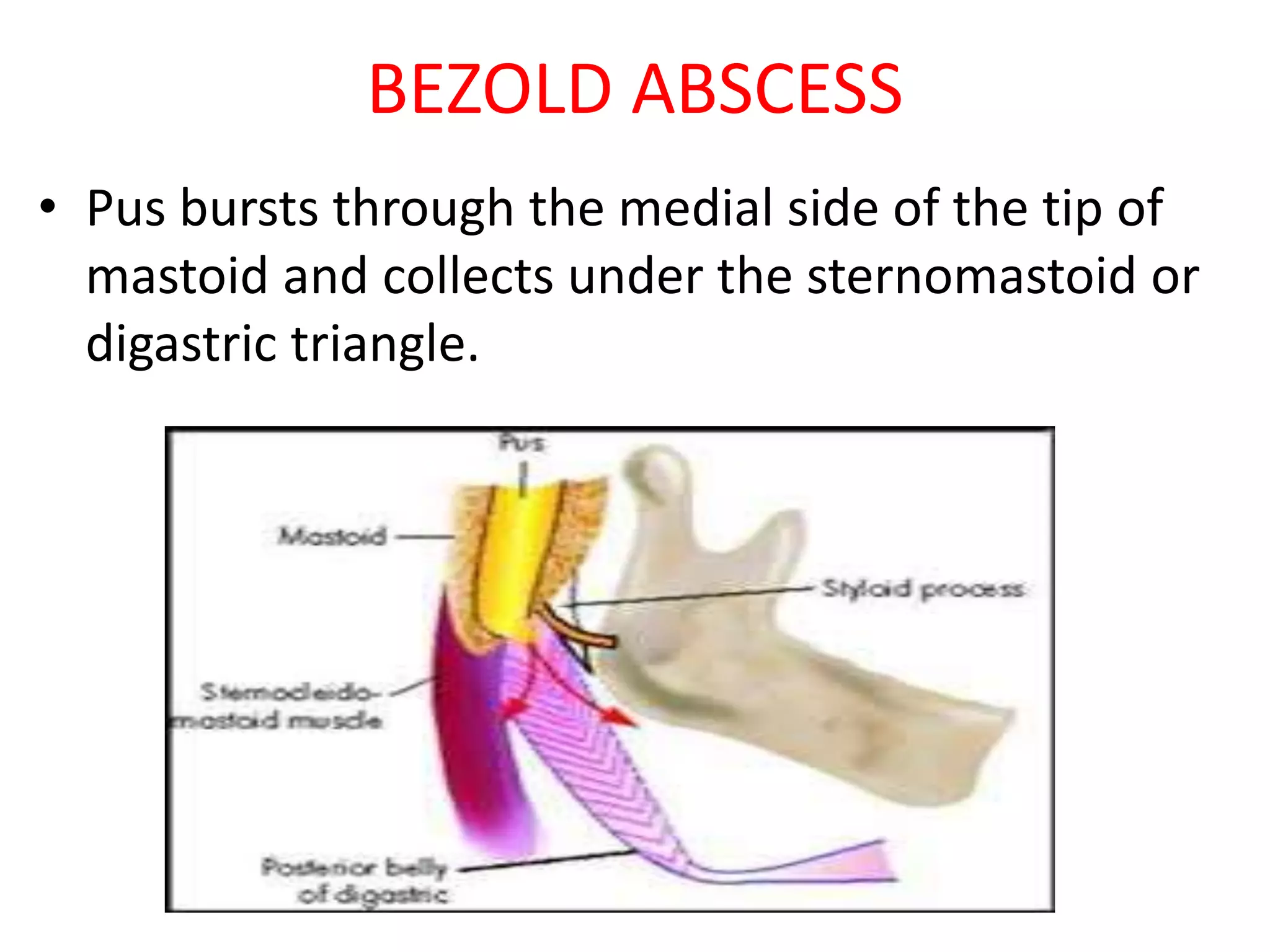EXTRACRANIAL /INTRATEMPORAL COMPLICATIONS OF CSOM | PPTX