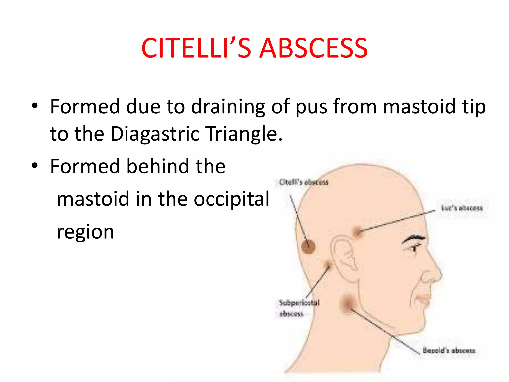 EXTRACRANIAL /INTRATEMPORAL COMPLICATIONS OF CSOM | PPTX