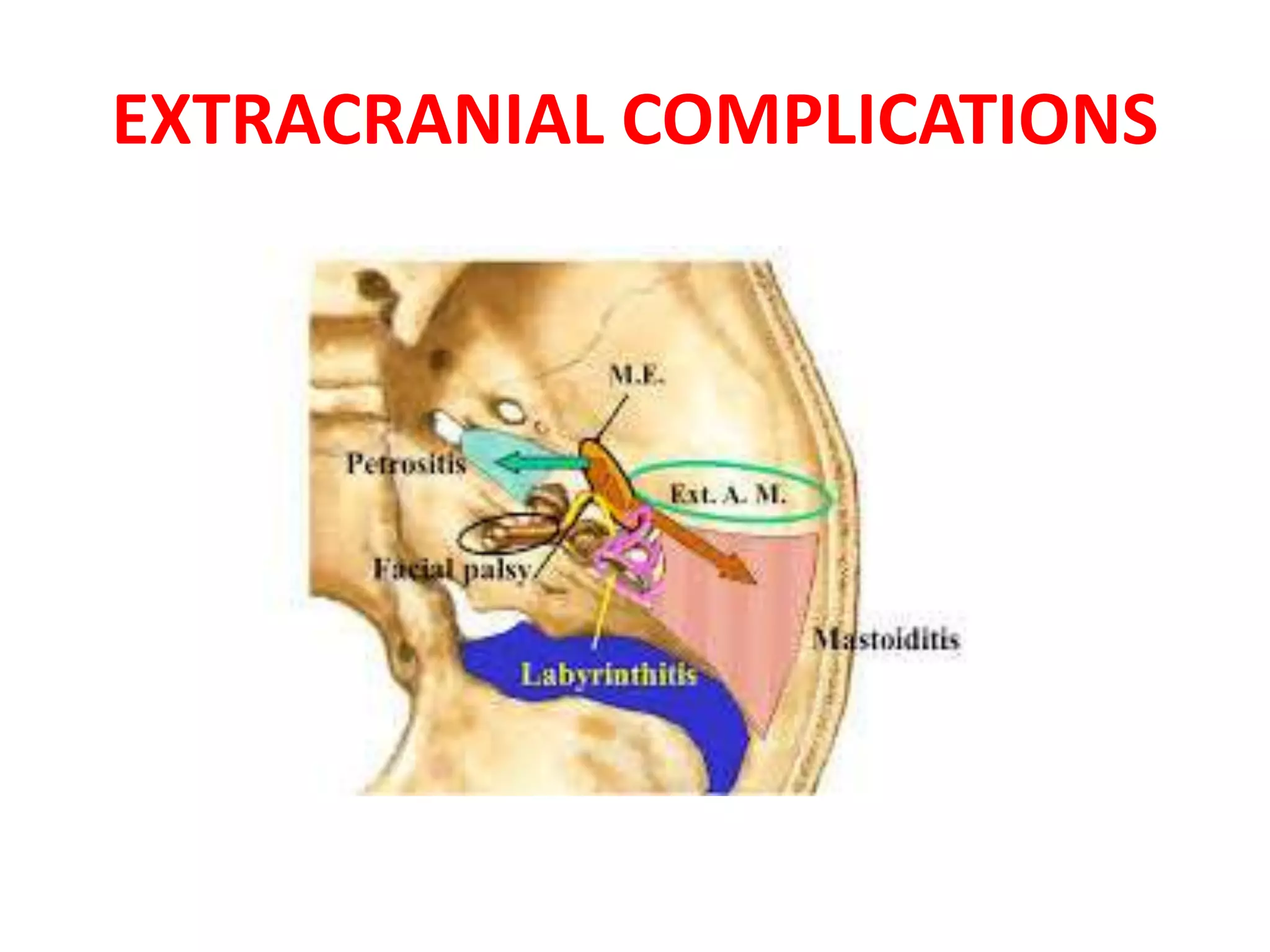 EXTRACRANIAL /INTRATEMPORAL COMPLICATIONS OF CSOM | PPTX