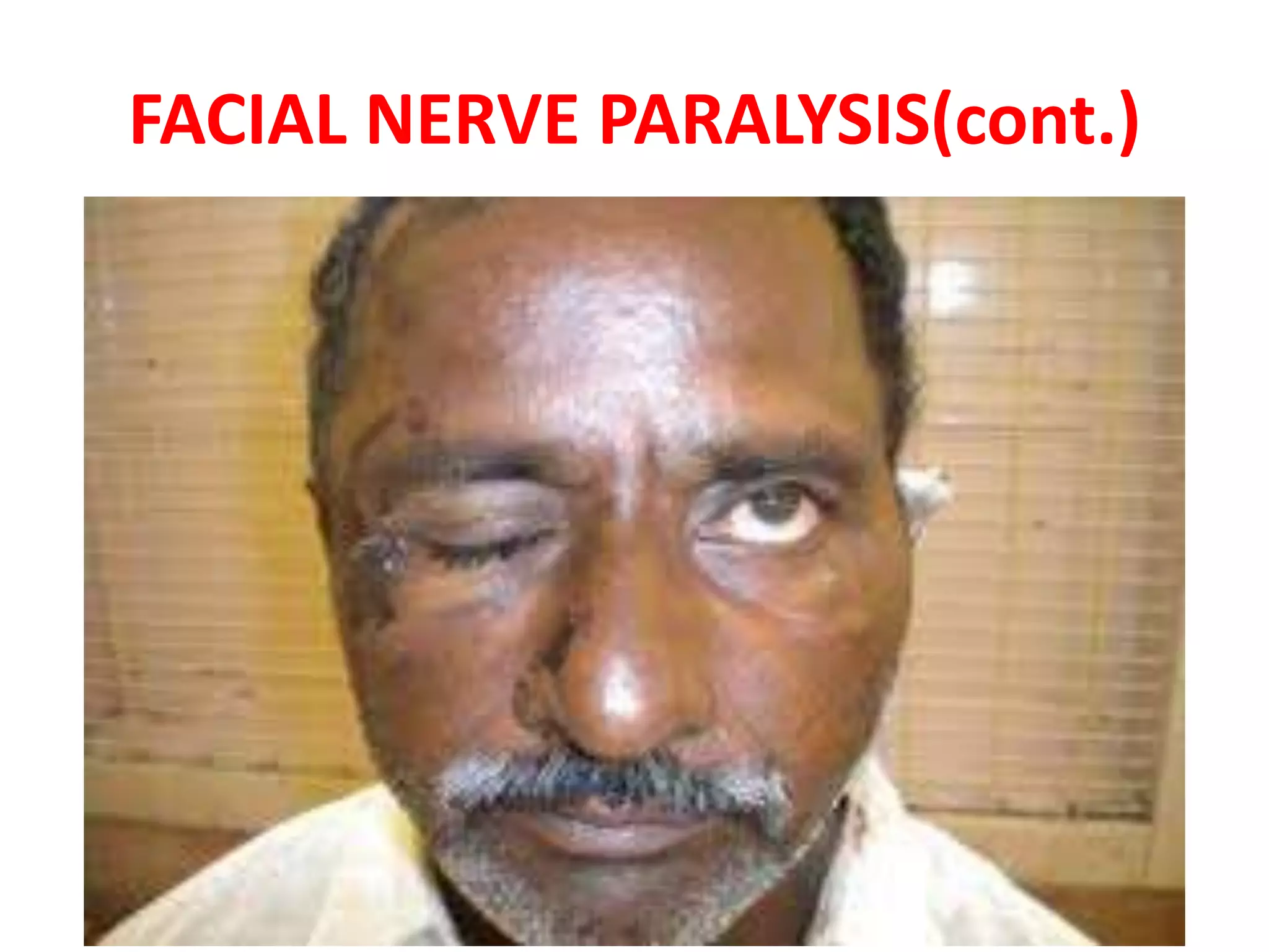 EXTRACRANIAL /INTRATEMPORAL COMPLICATIONS OF CSOM | PPTX