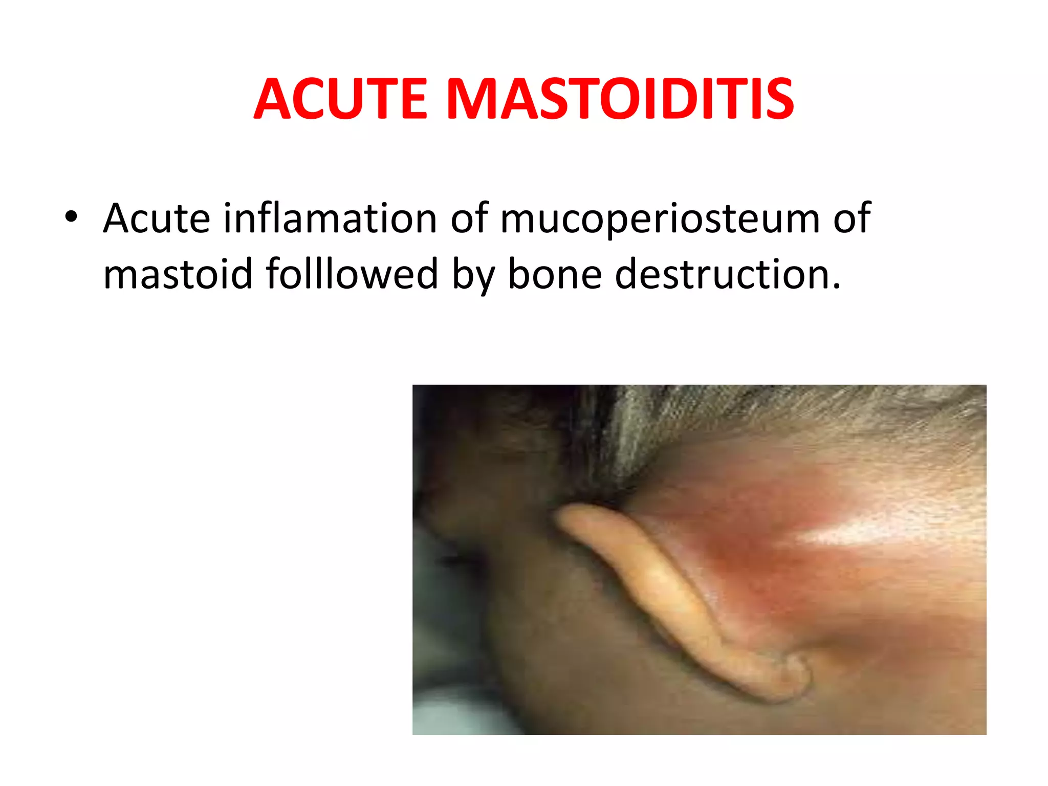EXTRACRANIAL /INTRATEMPORAL COMPLICATIONS OF CSOM | PPTX