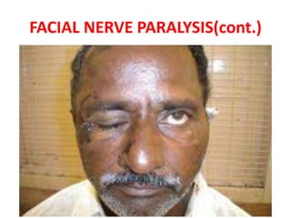 EXTRACRANIAL /INTRATEMPORAL COMPLICATIONS OF CSOM | PPTX