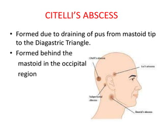 EXTRACRANIAL /INTRATEMPORAL COMPLICATIONS OF CSOM | PPT