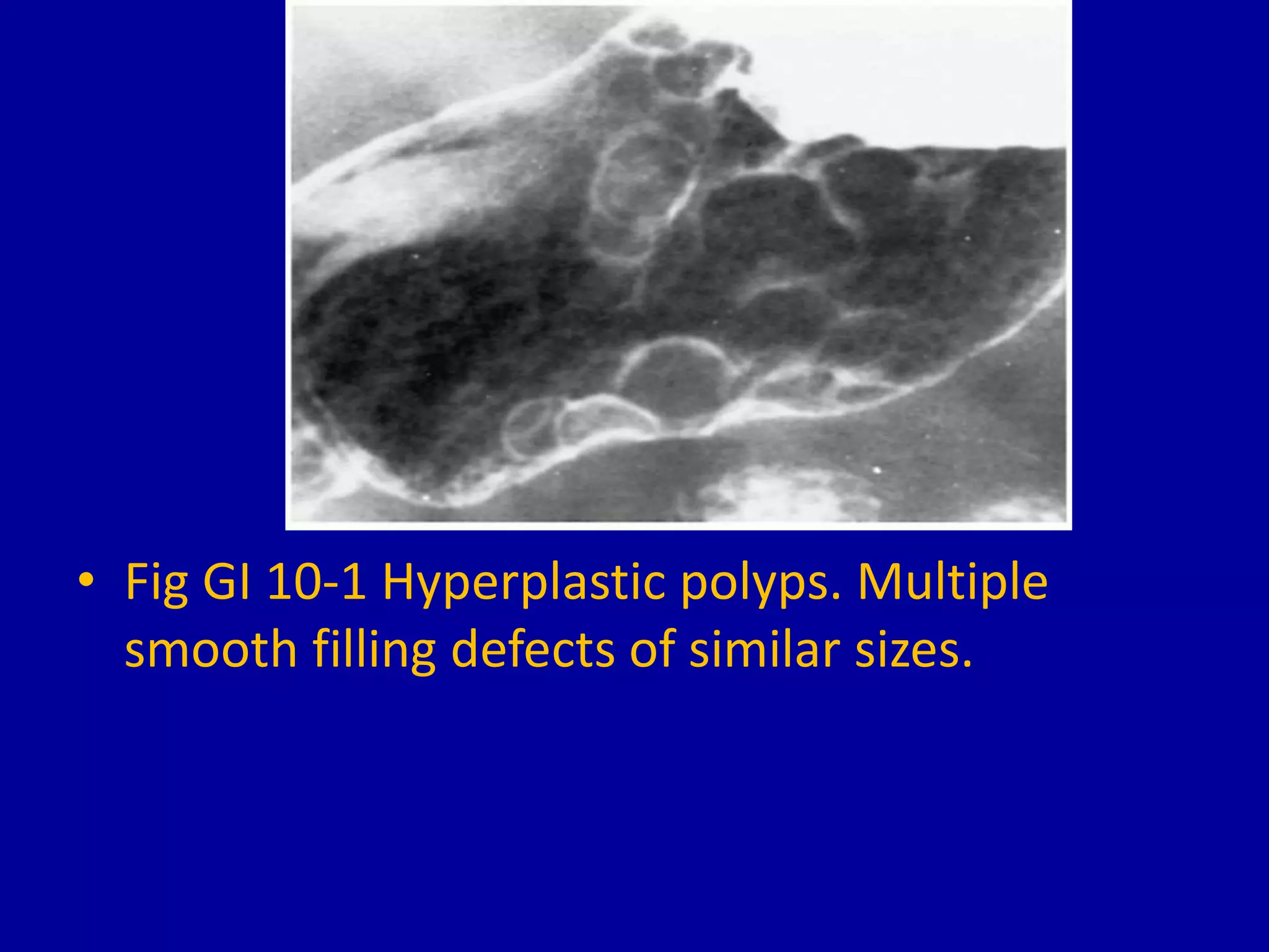 10 filling defects in the stomach | PPTX