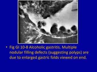 10 filling defects in the stomach | PPTX
