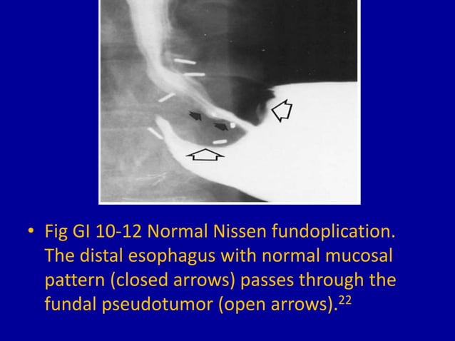 10 filling defects in the stomach | PPTX