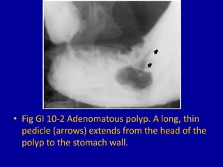 10 filling defects in the stomach | PPTX