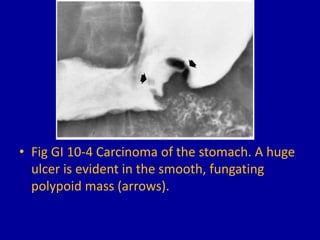 10 filling defects in the stomach | PPTX